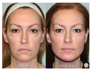 Y-Lift: Effective and Convenient Method of Face Lift and Sculpting