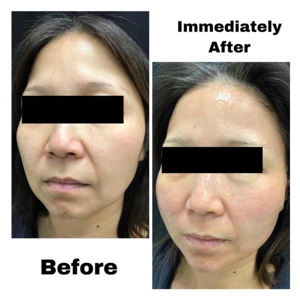 MINT™ PDO - Minimally Invasive Nonsurgical Thread PDO in Victoria, Texas